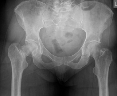 Een jonge vrouw met een acuut pijnlijke heup | SpringerLink