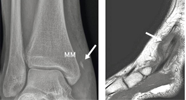 De onverwachte uitkomst van een enkeldistorsie | SpringerLink