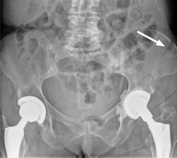 Os iliumfractuur na spongiosaplastiek | SpringerLink