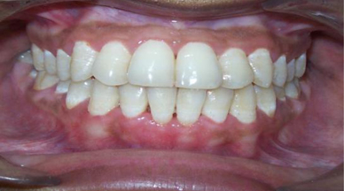Non-plaque-induced gingivitis associated with nicotinamide | SpringerLink