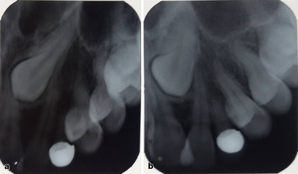 Evaluation of radiographic techniques for localization of impacted ...