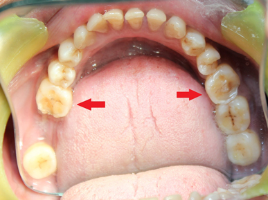 Interplay of occlusal forces and the periodontium | SpringerLink