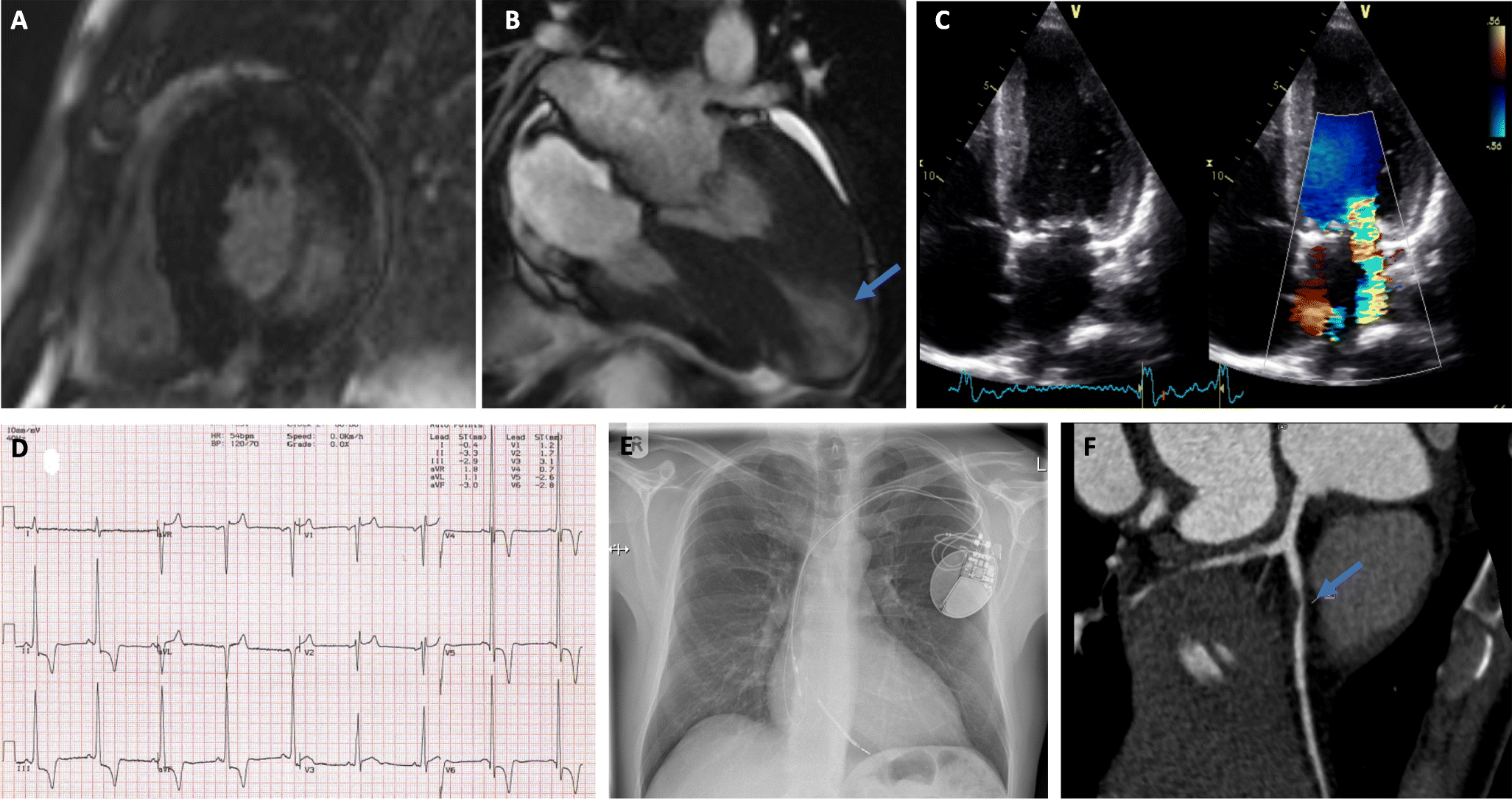Anderson-Fabry disease in heart failure | SpringerLink