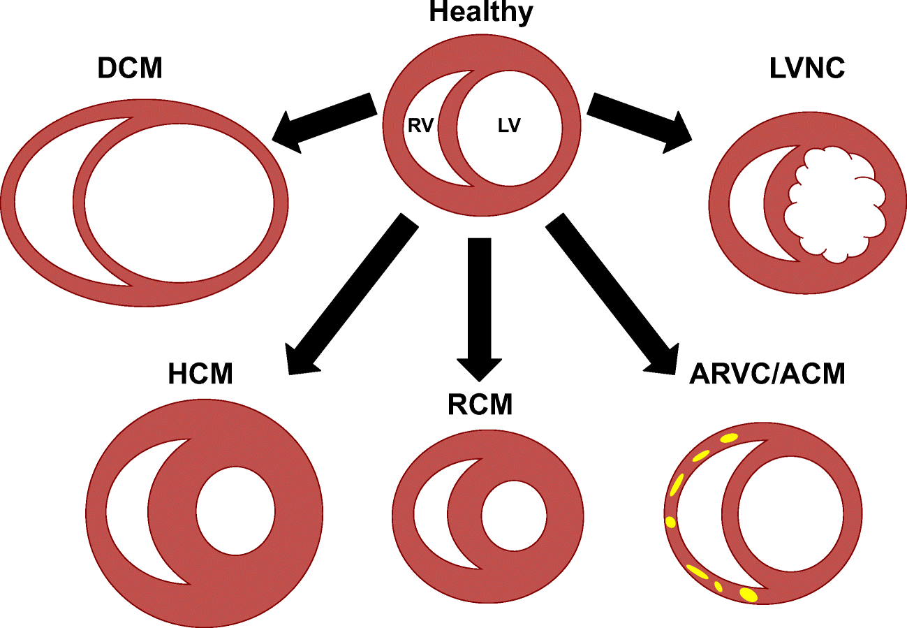 Non-sarcomeric causes of heart failure | SpringerLink