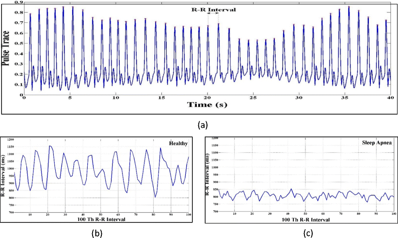 Using respiratory sinus arrhythmia to detect obstructive sleep apnea ...