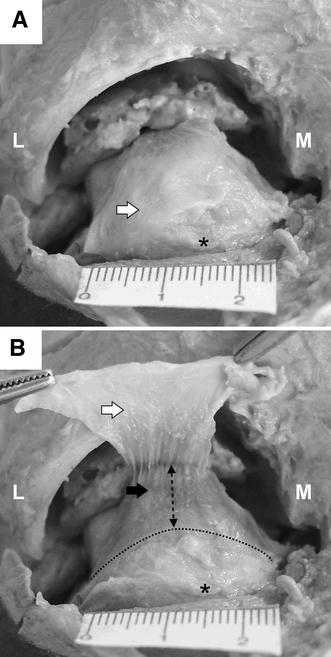 The human superior tarsal muscle (Müller’s muscle): a morphological ...
