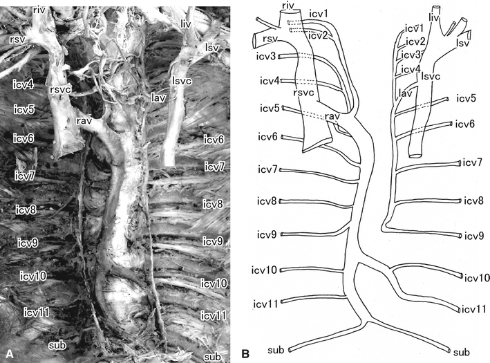 Classification of persistent left superior vena cava considering ...