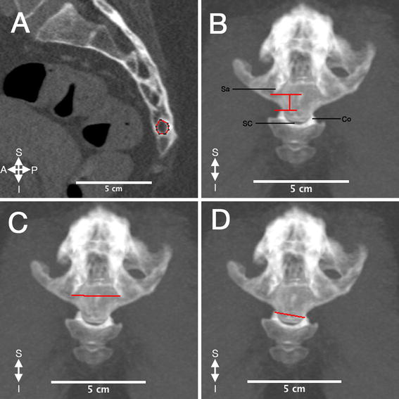 The anatomy of the sacrococcygeal cornual region and its clinical ...