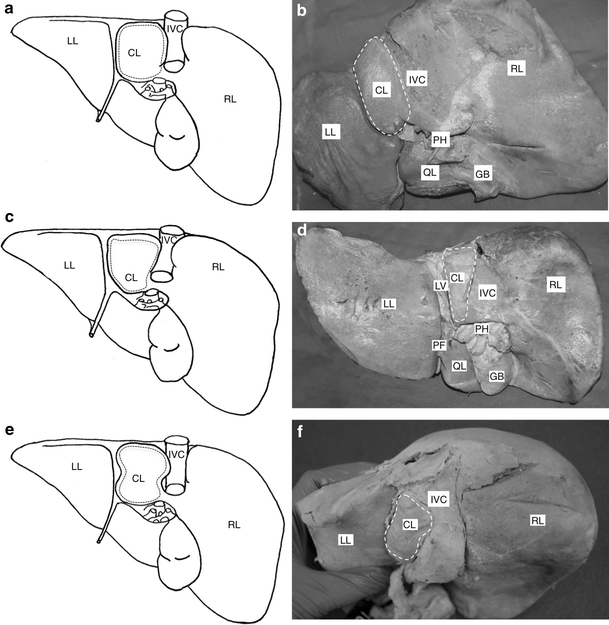 Morphology and morphometry of the caudate lobe of the liver in two ...