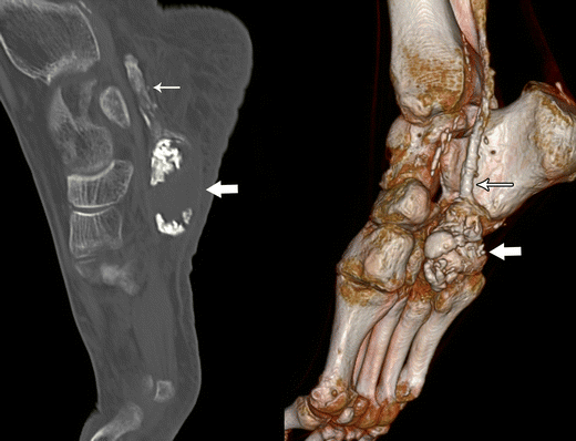 Calcified angioleiomyoma of foot arising from the posterior tibial ...