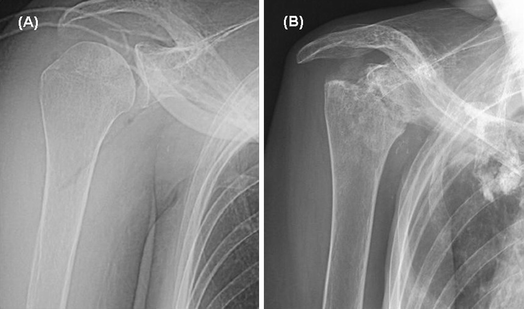 Arthroscopic debridement with continuous irrigation for septic ...