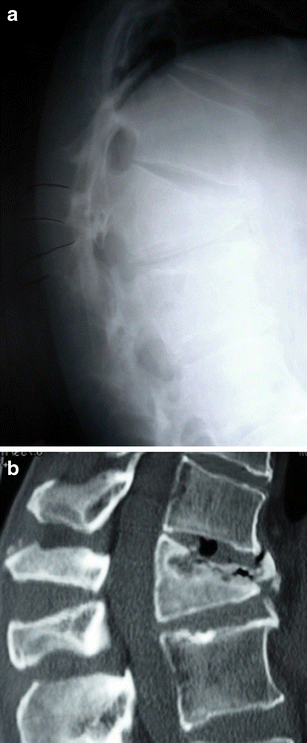 A chronic flexion-distraction injury with a “fistulous wither” on the ...
