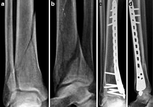 Simple articular extension did not affect the excellent results of MIPO ...
