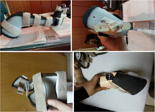 A knee-ankle-foot orthosis in treatment of talipes equino varus (TEV ...