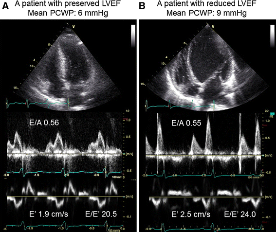 Echocardiographic estimation of pulmonary capillary wedge pressure ...