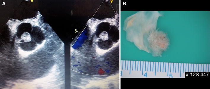 An echogenic mass on the aortic valve | SpringerLink
