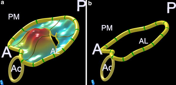 Discrimination between fibroelastic deficiency and Barlow disease using ...
