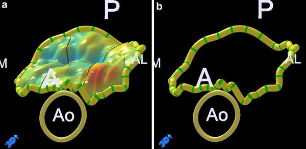 Discrimination between fibroelastic deficiency and Barlow disease using ...