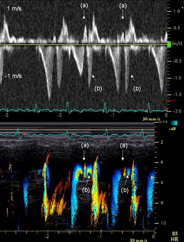 Mid-systolic flow reversal in a patient with mid-ventricular ...