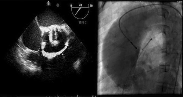 Unicuspid aortic valve in a middle-aged man: a rare case report ...