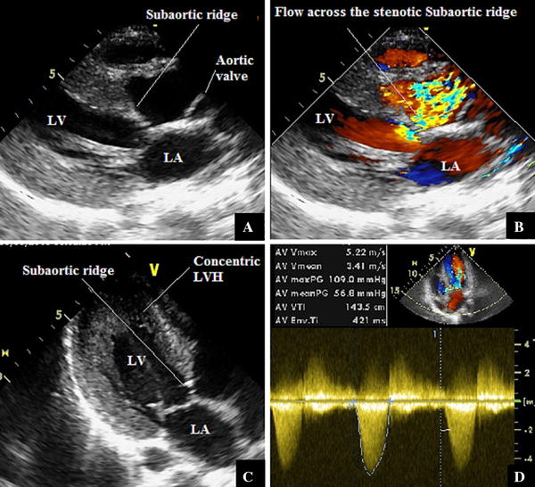 A case with discrete fibromuscular subaortic stenosis: evaluation by ...