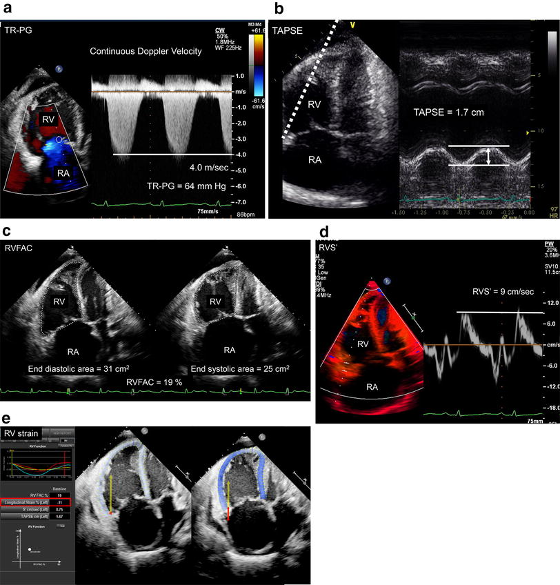 Rest and exercise echocardiography for early detection of pulmonary ...