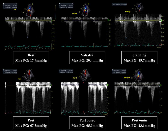 Exercise stress echocardiography in hypertrophic cardiomyopathy ...
