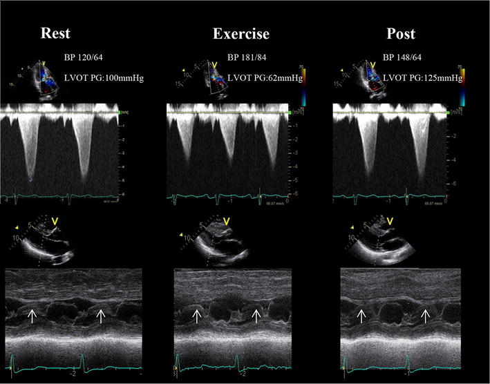 Exercise stress echocardiography in hypertrophic cardiomyopathy ...