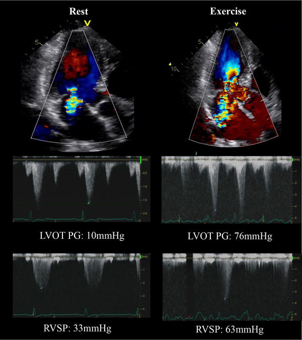 Exercise stress echocardiography in hypertrophic cardiomyopathy ...