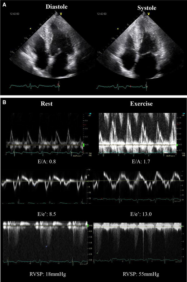 Exercise stress echocardiography in hypertrophic cardiomyopathy ...