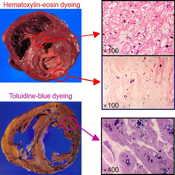 Fabry disease | SpringerLink
