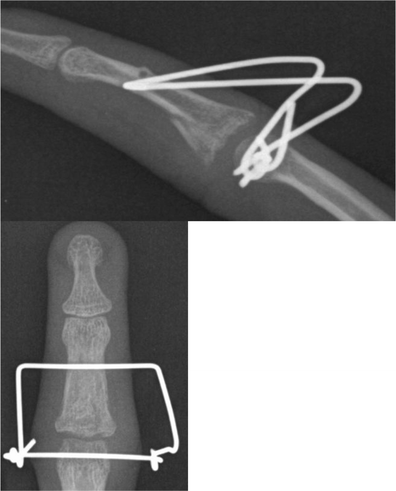Early Results of A Simple Distraction Dynamic External Fixator in Management of Comminuted Intra ...