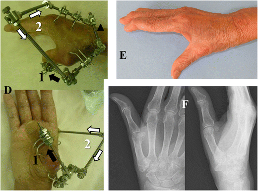 Correction of a Hyperextension Deformity at the Metacarpophalangeal ...