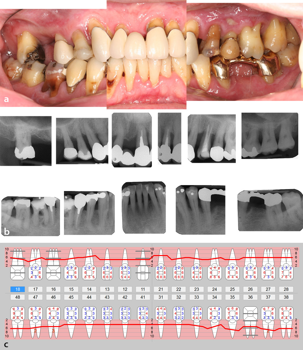 Schwere chronische Parodontitis | SpringerLink