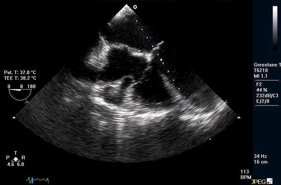 An echolucent structure on the anterolateral wall of the right atrium ...