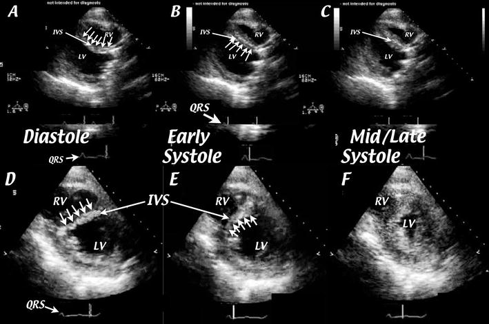 Case report: paradoxical ventricular septal motion in the setting of ...
