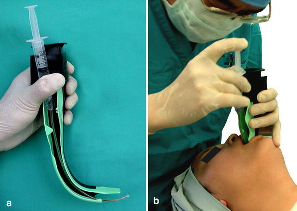 Airway topical anesthesia using the Airtraq® laryngoscope in patients ...