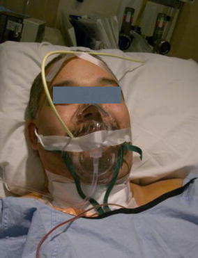 Brief review: Supplementing oxygen through an airway exchange catheter ...
