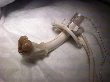Failure of both suction catheter passage and bronchoscopy to diagnose ...