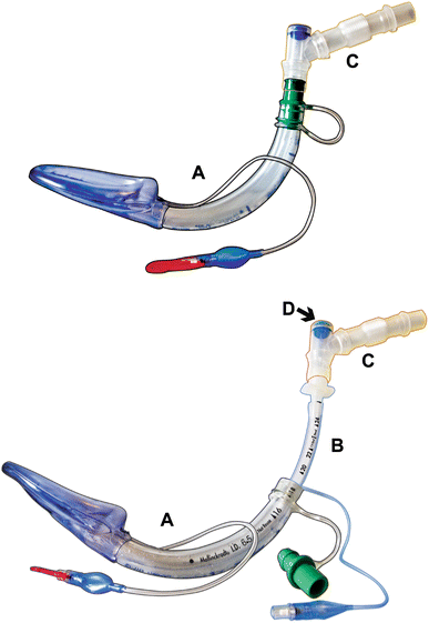 Awake bronchoscopic intubation through an air-Q® with the application ...