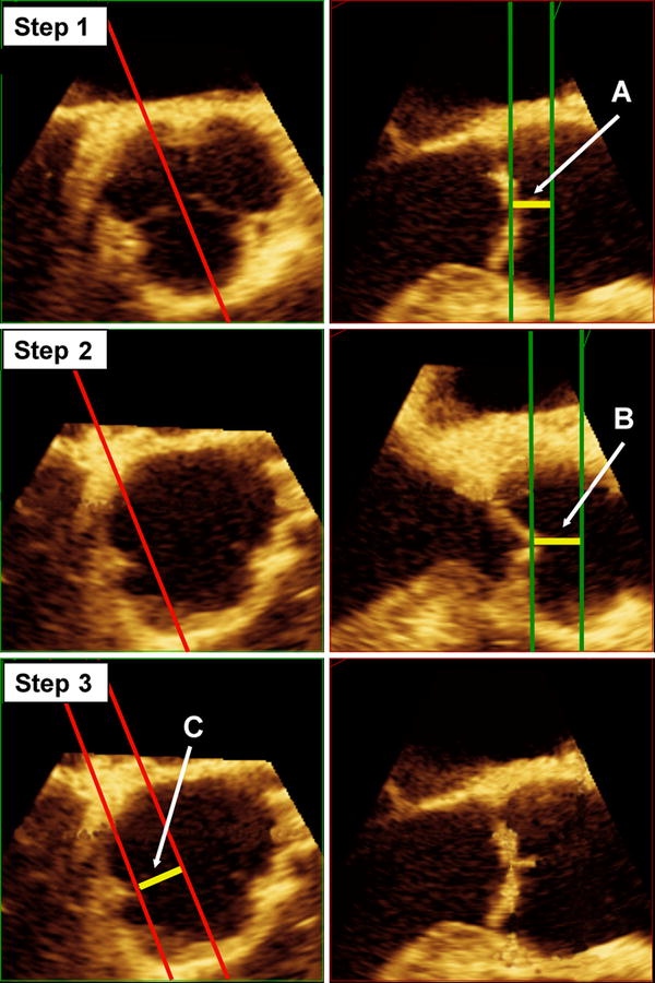 Measuring aortic valve coaptation surface area using three-dimensional ...