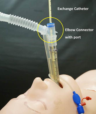 Tracheal extubation with a laryngeal mask airway and exchange catheter ...