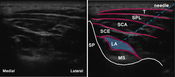 Multifidus cervicis plane block is effective for cervical spine surgery ...