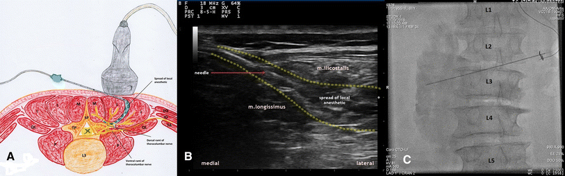 Ultrasonography-guided modified thoracolumbar interfascial plane block ...