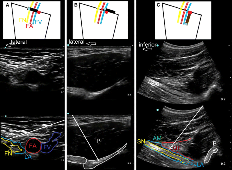 S O F T block ( Sciatic, Obturator and Femoral nerve block Technique ...