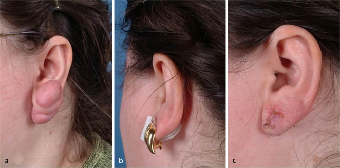 Die Therapie des Keloids der Ohrmuschel | SpringerLink
