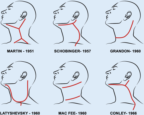 „Neck dissection“ | SpringerLink