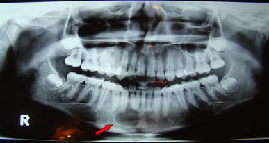 Traumatic Bone Cyst of Mandible | SpringerLink