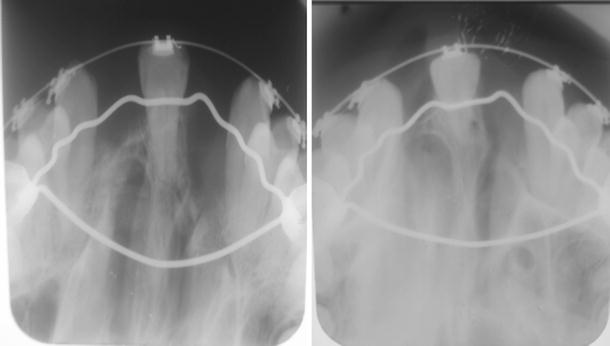Mid Versus Late Secondary Alveolar Cleft Grafting Using Iliac Crest ...