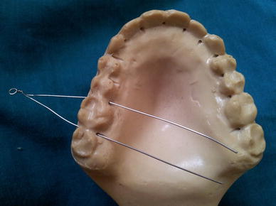 A New Simplified Technique for Intermaxillary Fixation by Loop-Designed ...